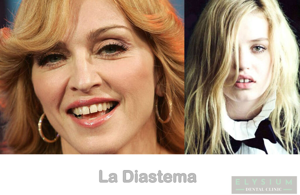 Los Dientes Separados: Diastema - Tu clinica dental en Madrid