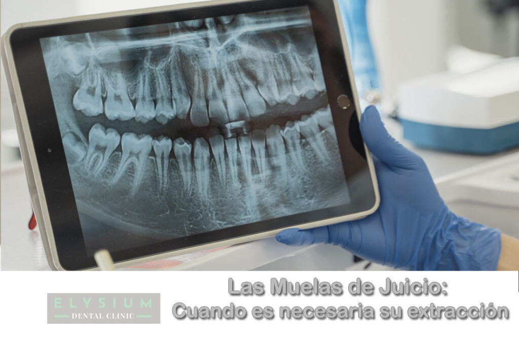 Las muelas del juicio y su extracción - Blog Dental - Elysium